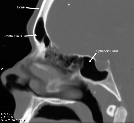 Chronic Sinusitis Information - Nasal & Sinus Center - Dr. Goyal